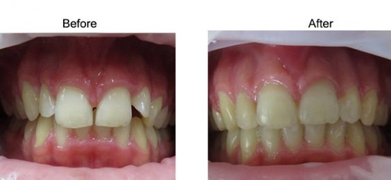 Quick Straight Teeth Noosa | Noosa Parade Dental Care